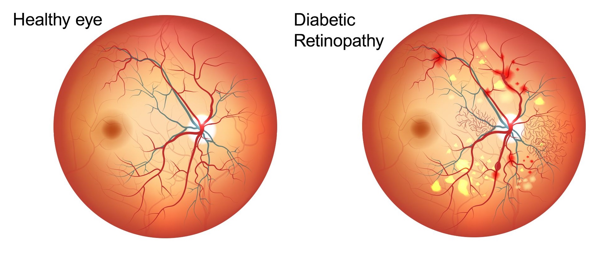 Diabetic Retinopathy: Understanding and Managing Vision Health - DR ...