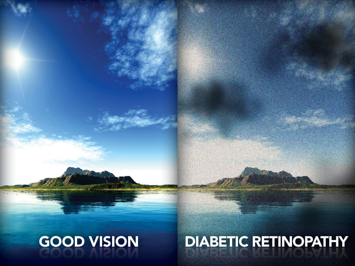 Diabetic Retinopathy: Understanding and Managing Vision Health - DR. AHMED EL KHASHAB