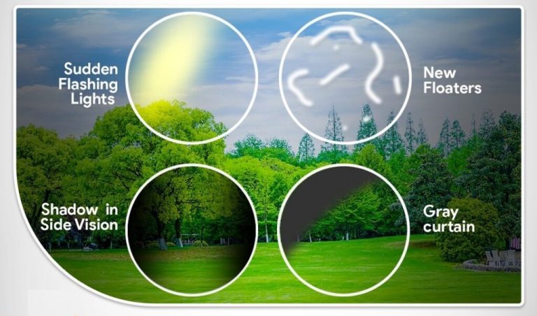 Retinal Detachment Surgery: Restoring Sight and Preventing Vision Loss - DR. AHMED EL KHASHAB